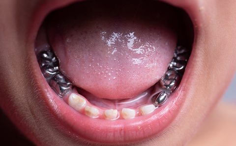 Sedation Dentistry - Panther Pediatric Dentistry